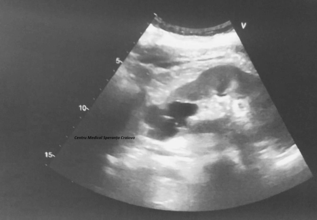 Chisturi Renale ‣ Clinica Speranța Craiova