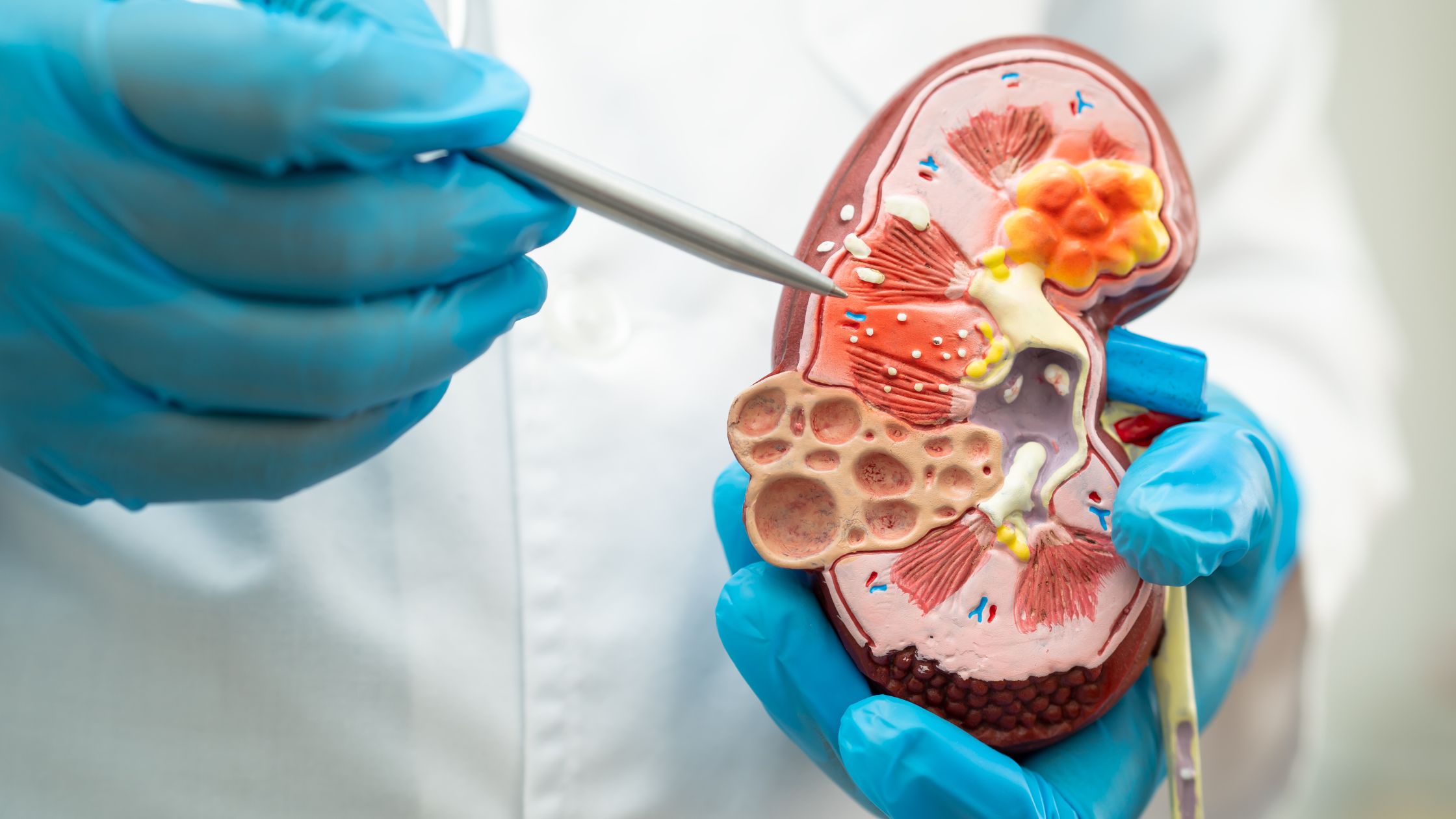 Semne Ca Ai Probleme Cu Rinichii ‣ Clinica Speranța Craiova